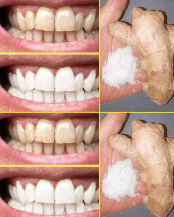 Whiten Your Teeth Instantly with This 2-Minute Ginger and Salt Trick ...